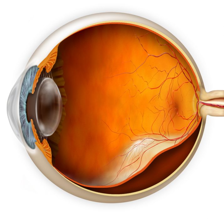 Ocular Emergency: Retinal Detachment | Eye Specialist Institute