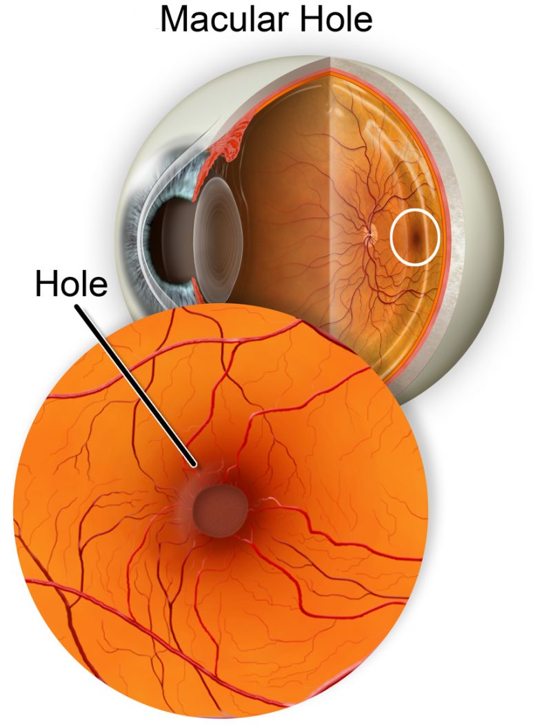 Common Retinal Problems | Eye Specialist Institute | Gold Coast Clinics