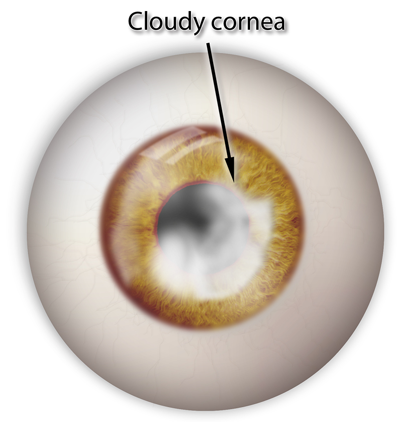 Fuchs Endothelial Dystrophy | Gold Coast | Eye Specialist Institute
