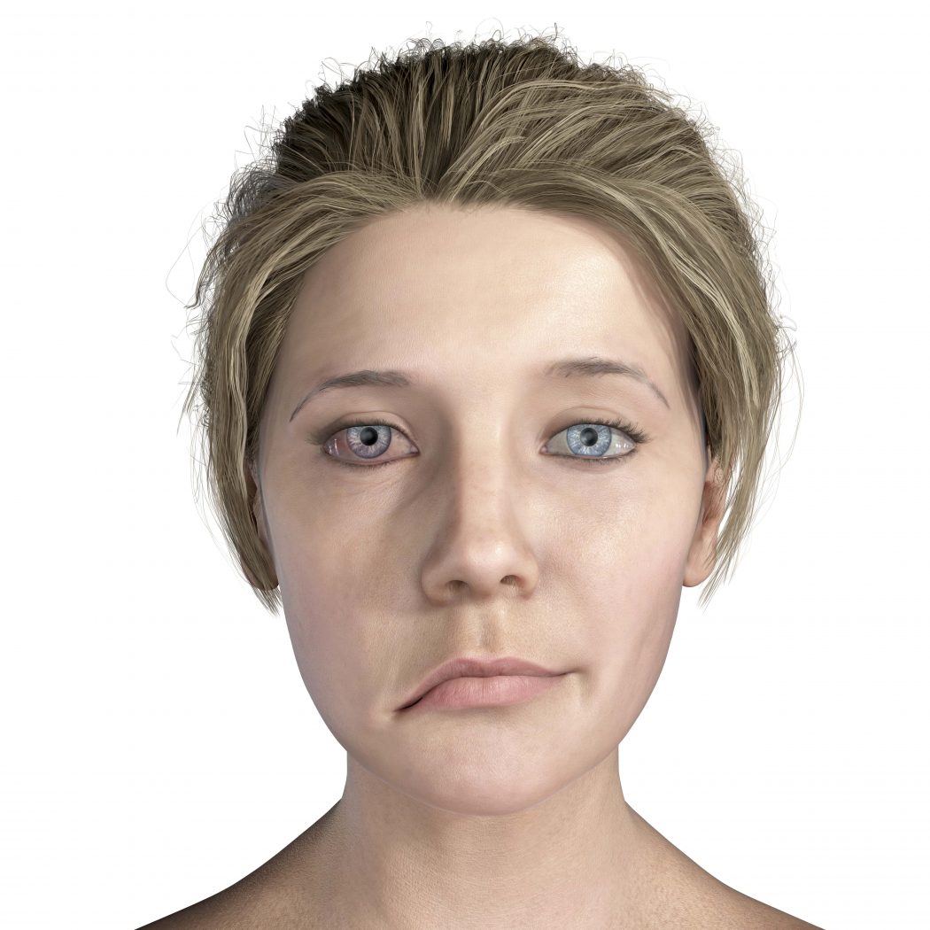 Facial Palsy, Causes & Treatment | Gold Coast | Eye Specialist Institute